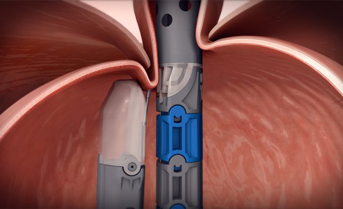 Novo tratamento para refluxo, TIF chega a Valinhos (SP) - HOSPITAIS BRASIL