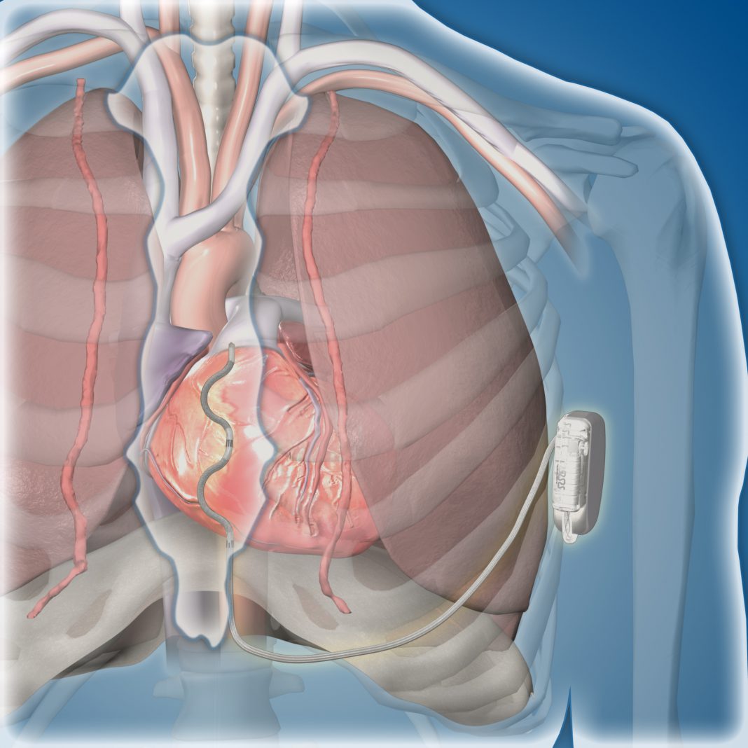 Dia Mundial do Coração: Novo desfibrilador interrompe sem dor 70% dos ...